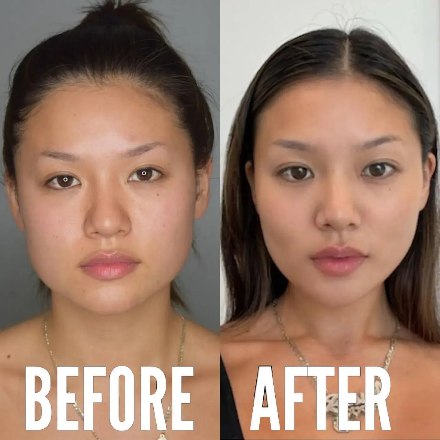 Buccal Fat Removal Before and After - Before After Journey