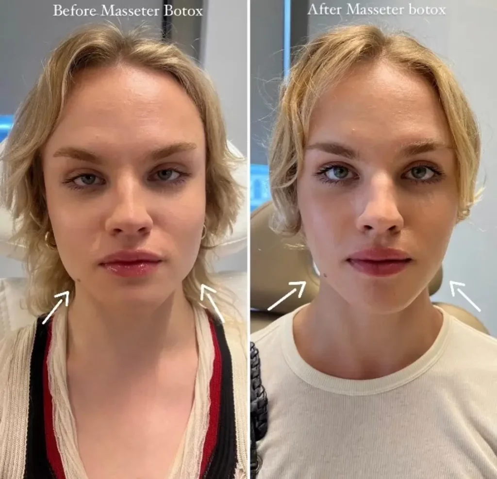Masseter Botox Before And After Before After Journey Masseter Botox Before And After Before After Journey