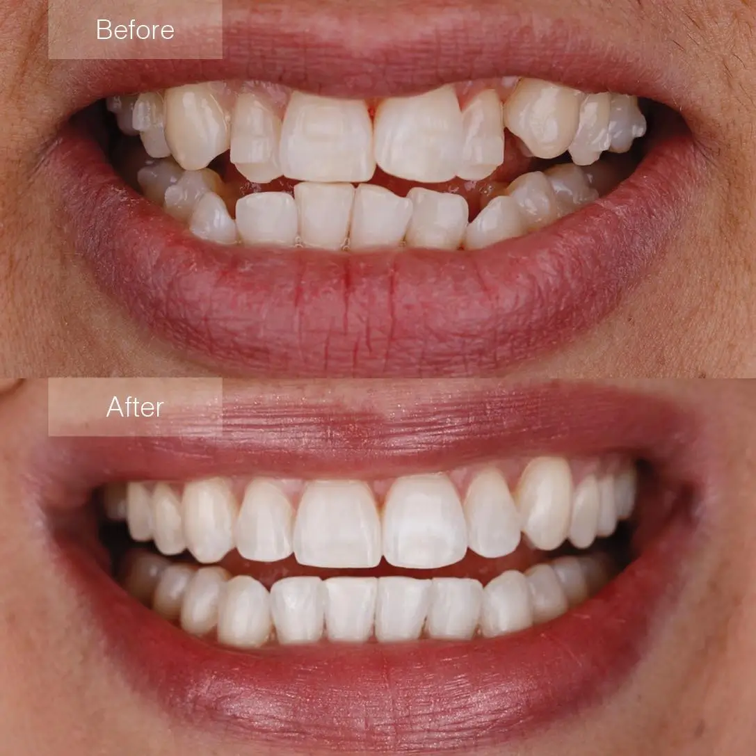 Invisalign Before and After - Before After Journey
