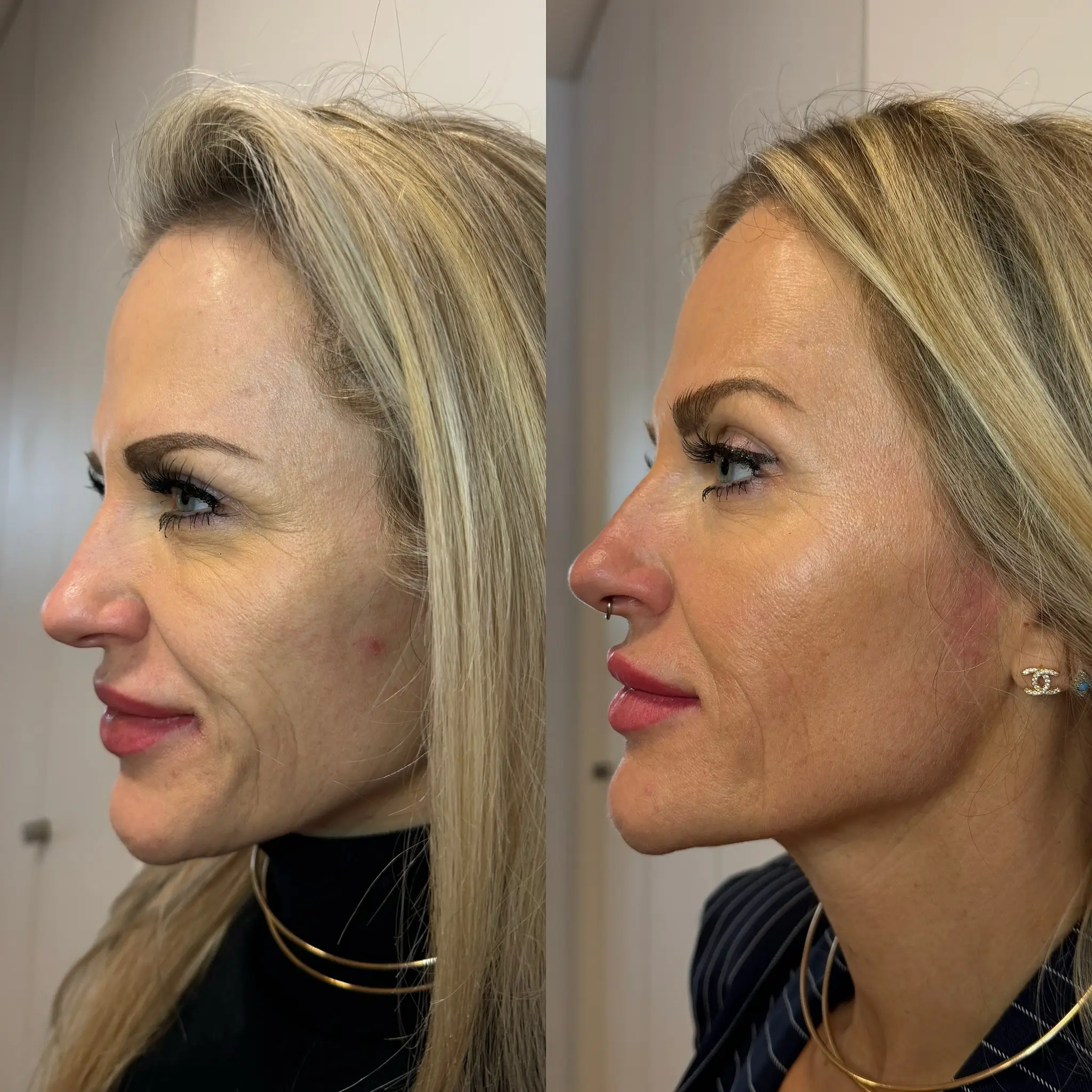 Morpheus8 Before and After - Before After Journey