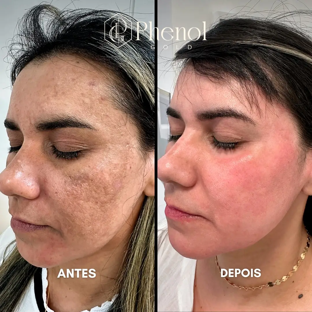 Phenol Peel Before and After - Before After Journey